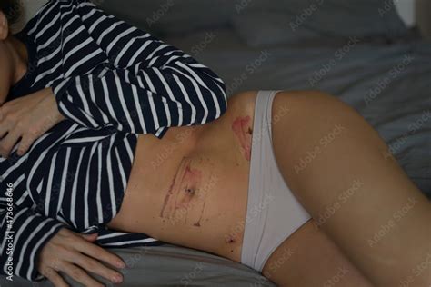 Consequences After Peritonitis Stock Photo Adobe Stock