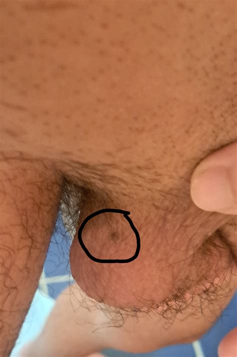 Black Spot On My Right Nut R Medical
