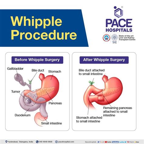 Best Hospital For Whipple Procedure In Hyderabad Surgery And Cost