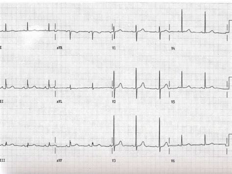 ecg ppi asd