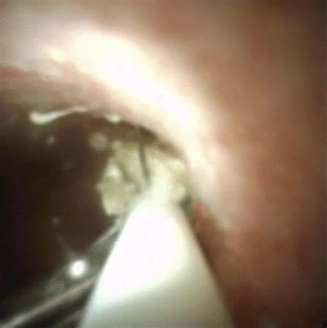 Cholangioscopy Guided Clip Retrieval From The Common Bile Duct Download Scientific Diagram