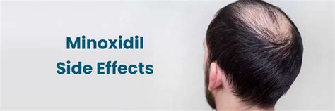 Minoxidil Side Effects Topical Vs Oral Side Effect And How To Manage