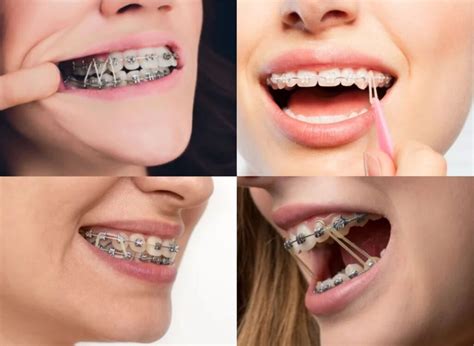 What Do Rubber Bands Do On Braces OC Dental Center