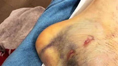 La Impactante Imagen Del Tobillo Maltrecho De Una De Las Figuras De La Selecci N De Croacia