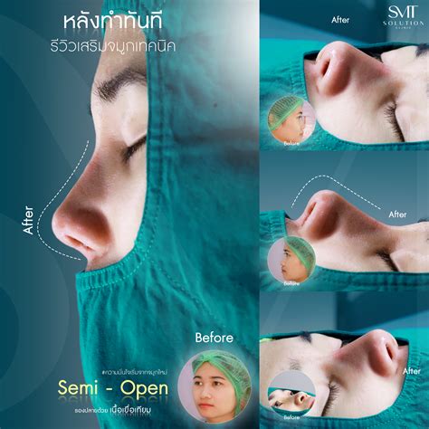 เทคนิค Smt Solution Clinic ศัลยกรรมและความงามเชียงใหม่ Facebook