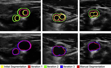 Segmentation Results Using The Described Method On Ultrasound For