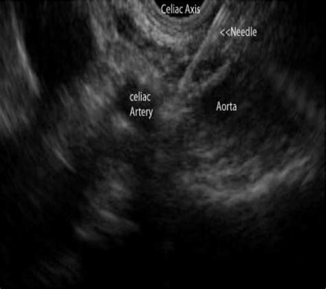 How Accurate Is Endoscopy For Celiac At Catherine Dorsey Blog