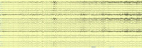 Alteration Of Spatial Reasoning As Primary Seizure Manifestation