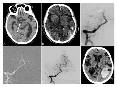A Baseline Imaging From An Octogenarian Woman With Basilar Artery