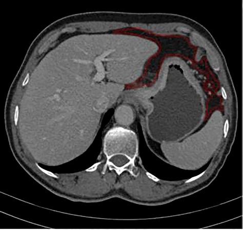 Figure 2 From Practical Nomogram Based On Comprehensive Ct Texture Analysis To Preoperatively