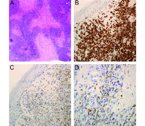 A Skin Biopsy Showing A Diffuse Lymphoid Infiltration Of The Dermis