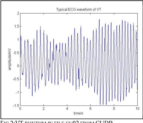 Figure 2 From A Shockable Rhythm Detection Algorithm Using Slope Variability Semantic Scholar