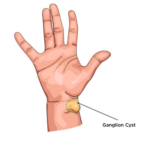 Hand And Wrist Surgery In Leeds Skin Surgery Clinic