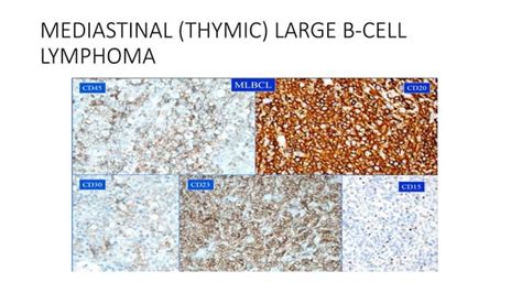Hodgkins Lymphoma Ppt Pptx
