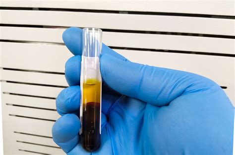 Can ‘toxic Bilirubin Treat A Variety Of Illnesses Science Aaas