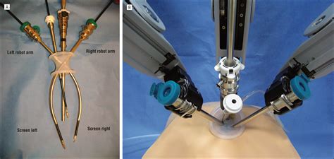 Laparoscopic Cholecystectomy Ports