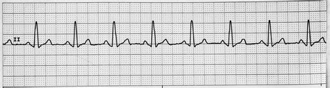 74 Ecg Patterns And Dysrhythmias Nursing Advanced Skills