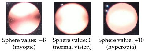 Red Reflex Ophthalmoscope