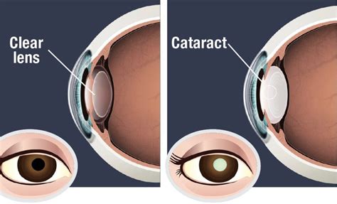 Cataracts Know Its Types Causes Symptoms And Treatments