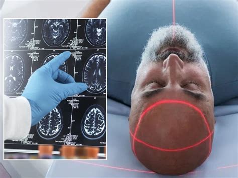 Dementia Dsb Can Reduce Risk Of Alzheimers Disease