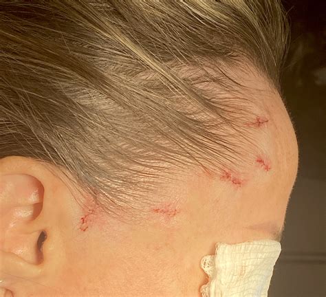 Right Multi Level Temporal Artery Ligations Completed Dr Barry Eppley