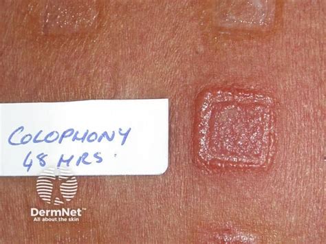 Hand Dermatitis Hand Eczema