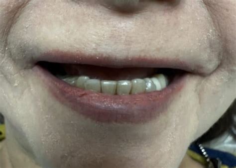 Upper Full Arch Fixed Screw Retained Hybrid Implant Prosthesis Case