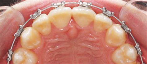 Fastbraces Near You Fastbraces In Spring