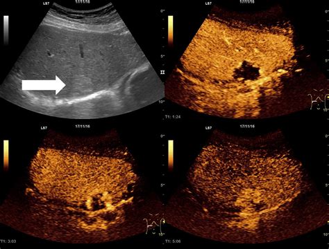 What Are Ultrasound Contrast Agents At Sean Swick Blog