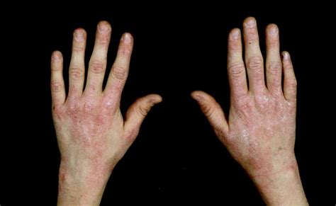 Dermatomyositis In The Hand Rheumexam Atlas