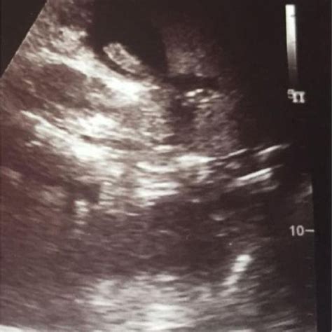 Pdf Gallbladder Ascariasis In Kosovo Focus On Ultrasound And Conservative Therapy A Case Series