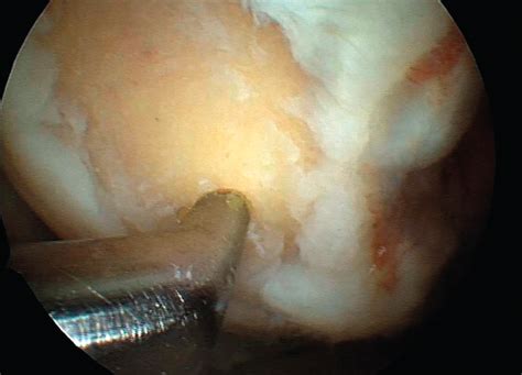 Microfractures Or Bone Marrow Stimulation Bms Evolution Of The