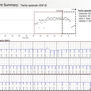 Implantable Loop Recorder Data Demonstrating An Episode Of Download Scientific Diagram