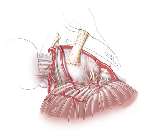 Trigeminal Neuralgia On Behance