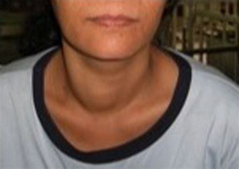 Primary Hyperparathyroidism Due To An Intrathyroidal Parathyroid Adenoma Associated With Chronic