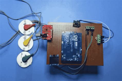 Ecg Analysis For Heart Disease Prediction With Vital Parameters