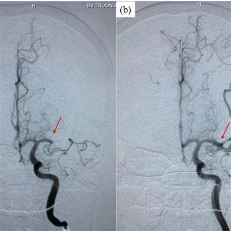 Dense Mca Sign On Non Contrast Enhanced Ct Scan Image Arrow Download Scientific Diagram