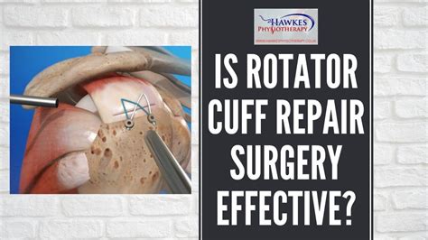 Rotator Cuff Tear After Surgery At Jesse Gisborne Blog