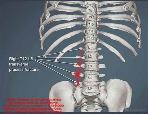 Transverse Process Fracture