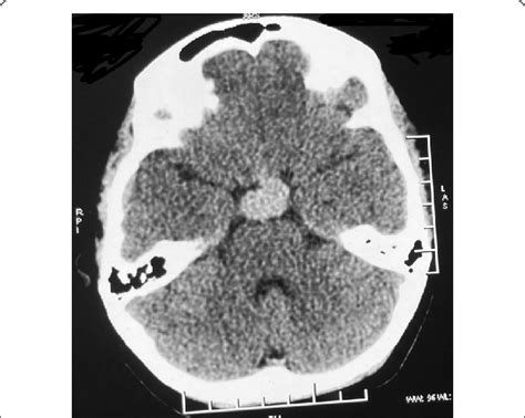 Ct Scan Of The Brain Showing Hyperdense Lesion In The Suprasellar Area