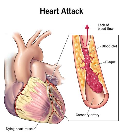 7009 Bradycardia Bradyarrhythmia Symptomatic Requiring Permanent Pace