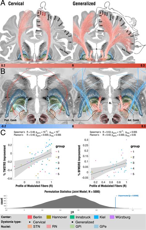Generalized Dystonia