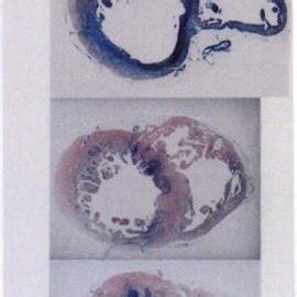 Technetium 99m Pyrophosphate Scintigrams Fromanterior A Leftanterior Download Scientific