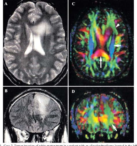 Figure 1 From Diffusion Tensor Imaging Of White Matter Tracts In