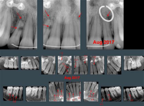 Multiple External Apical Root Resorption Tdo University