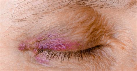 Ecchymosis Definition Causes And Treatment
