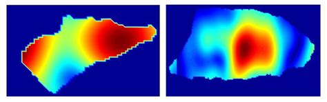 Millimetre Wave Imaging Delivers Non Invasive Skin Cancer Diagnosis Physics World