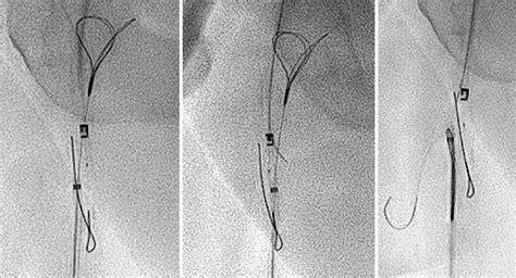 Lars Svensson On Linkedin Percutaneous Arterial Bypass For Long Fem