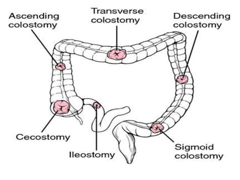 Colostomy Pptx Digestive Disorders Diseases And Conditions