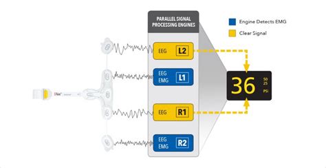 Masimo SedLine Brain Monitoring